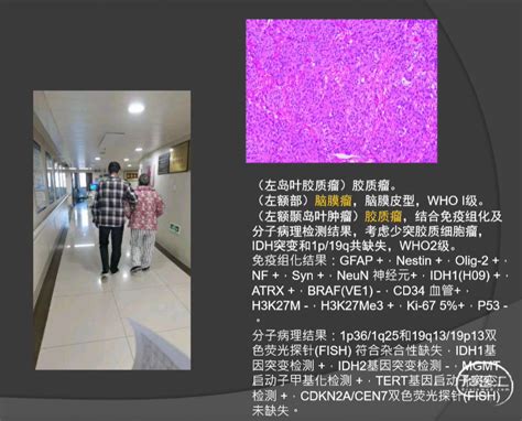 浙大二院石键主任医师 华科导航dti成像技术在岛叶脑肿瘤手术中的应用 脑医汇 神外资讯 神介资讯