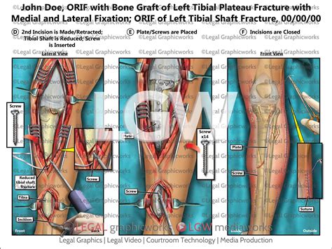 Orif With Bone Graft Of Left Tibial Plateau Fracture With Medial And L