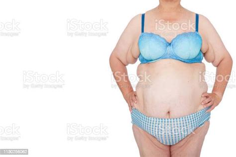 중간 아기와 극단적인 체중 감량 후 여분의 피부를 가진 여자 세 전에 Brachioplasty Panniculectomy