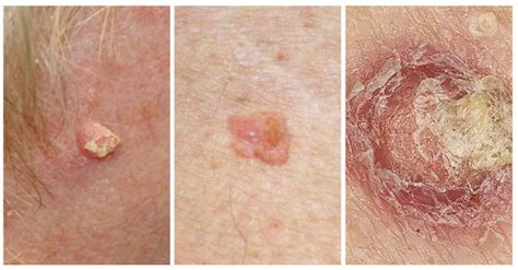 Non Melanoma Skin Cancer