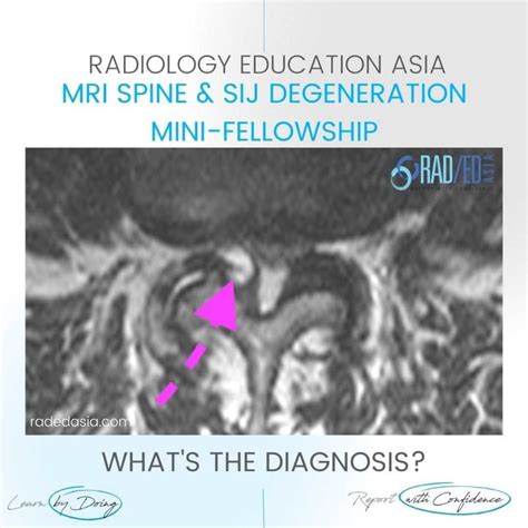 Facet Synovial Cyst Radiology Mri Lumbar Spine Radedasia