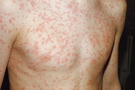 Measles Art For Sale Fine Art America