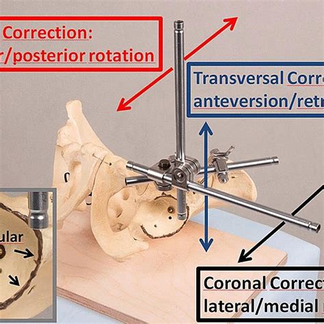 Radiographic Appearance Of The Crossover Sign Download Scientific Diagram