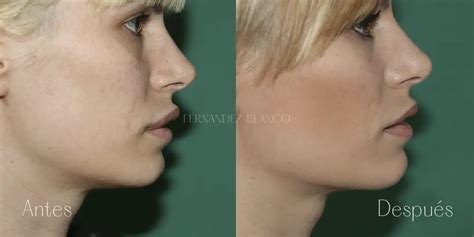 Marianas Case Before And After Cheiloplasty Fb