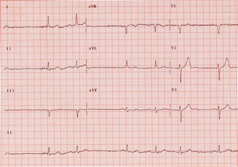 Sex Specific Associations Between Bmi And Waist Circumference In Atrial