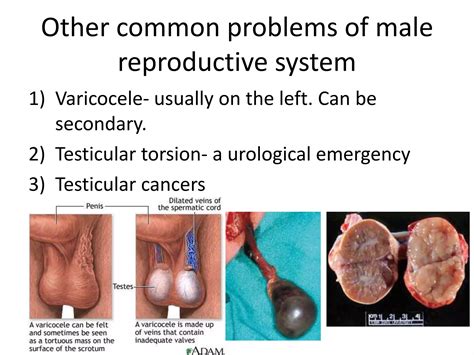 Prostate And Erectile Dysfunction And Other Common Male Reproductive Problems Pptx