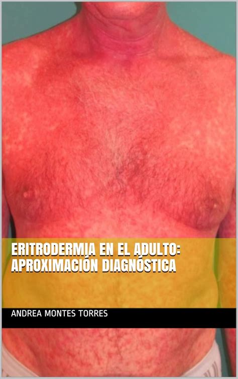 Eritrodermia En El Adulto AproximaciÓn DiagnÓstica Spanish Edition