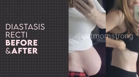 Diastasis Recti Before And After Get Mom Strong