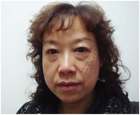 Preoperative Markings Of Lower Eyelids And Nasolabial Sulcus Before Download Scientific Diagram