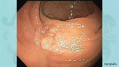 Kudos To You Learning Your Kudo Pit Patterns And Paris Polyp