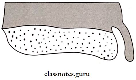 Post Insertion Problems In Complete Denture Class Notes