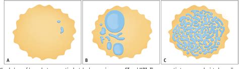Figure 1 From Large Duct Pancreatic Ductal Adenocarcinoma A