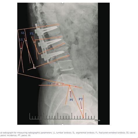 The Preoperative And Postoperative Radiographs Of Four Pedicle Screw