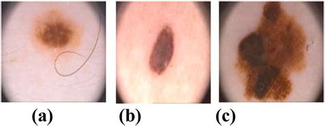 Sample Database Images A Normal Mole B Benign Tumour And C