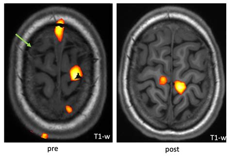 An Algorithm For Elective Amputation Combined With Targeted Muscle Reinnervation In Complex