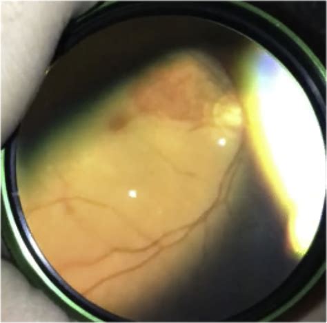 Demonstration Of Acute Retinal Ischemia On Diffusion Weighted Magnetic