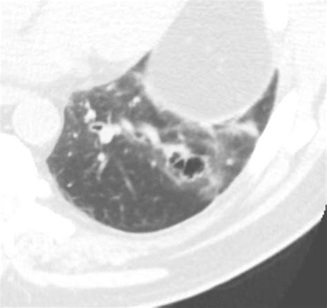 Faces Of Cavitating Nodules The Common Vein