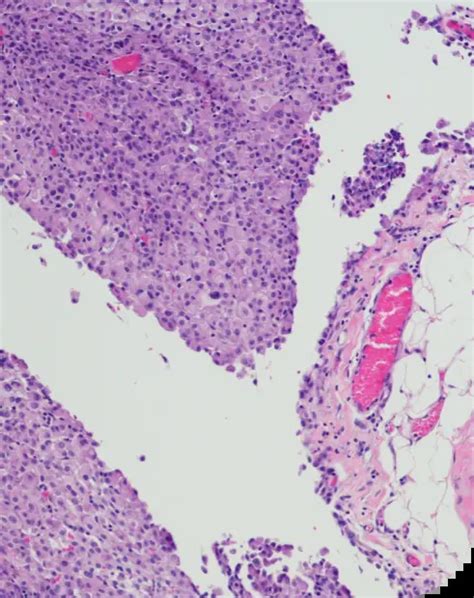 Mesothelioma Survival Rates The Lanier Law Firm