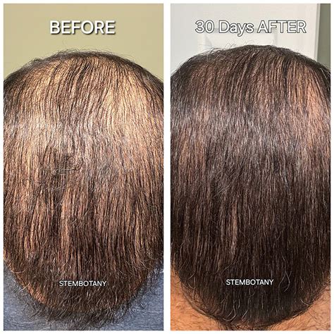 Stem Cell Scalp Serum Copper Peptide Hair Serum Scalp Treatment Serum Stem Cell Hair