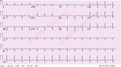 Left Anterior Fascicular Block