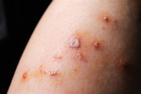 562 BEST Gangrene IMAGES STOCK PHOTOS VECTORS Adobe Stock