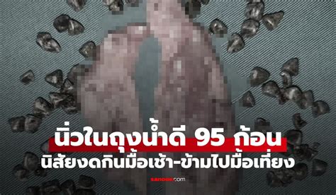 นาฬิกาชีวิตพัง หญิงมีนิ่วในถุงน้ำดี 95 ก้อน งดมื้อเช้า ข้ามไปมื้อเที่ยง อันตรายกว่าที่คิด