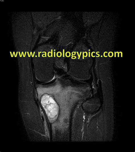 Unknown Case 16 Lytic Lesion In The Tibia What Is Your Differential