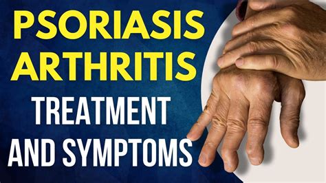 Psoriasis Arthritis Treatment And Symptoms Psoriatic Arthritis Youtube