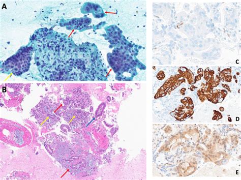 Distal Cholangiocarcinoma Case Report And Brief Review Of The Literature Pmc