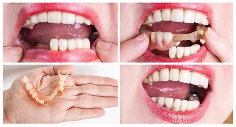 Flexible Partial Dentures Flexible Complete Bonadent Dental