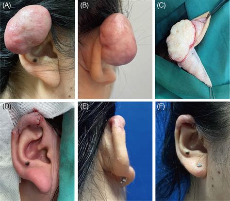 Showed Recurrent Keloids At The Auricular Rim And Appear With