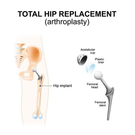 Hip Joint Replacement Msk Patient Portal Nhs Ayrshire And Arran