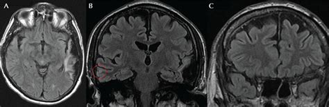 John Libbey Eurotext Epileptic Disorders Ictal Head Roll A Seizure