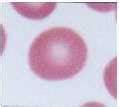 Kelainan Bentuk Eritrosit CocoQuiins Blog