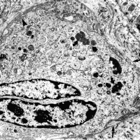 Electron Micrograph Left Ventricle Calf Depleted Of Vitamin E And