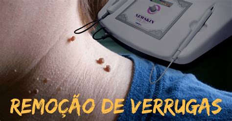 O Que é Jato De Plasma E Eletrocautério Indicações De Uso