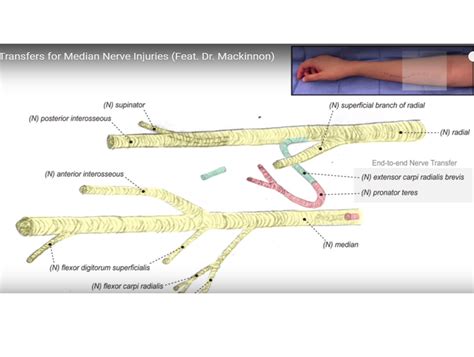 “nerve” Transfer For Median Nerve Injuries —