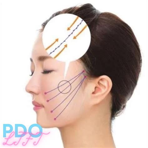 A Pdo Thread Lift Is A Procedural Technique Used To Lift Up The Skin Of