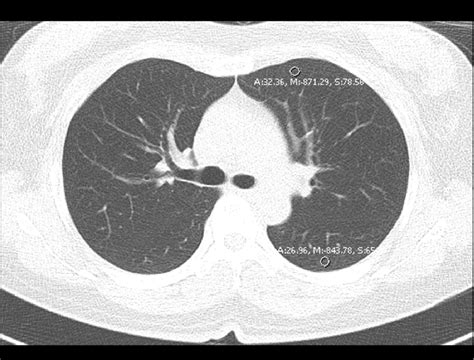 Figure 1 From Reduced Radiation Exposure Of The Female Breast During Low Dose Chest Ct Using