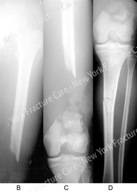 Complex Fractures New York Fracture Care