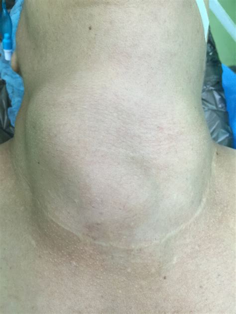 Difficult Total Thyroidectomy For Recurrent Multinodular Goiter Dr Raad Al Saffar