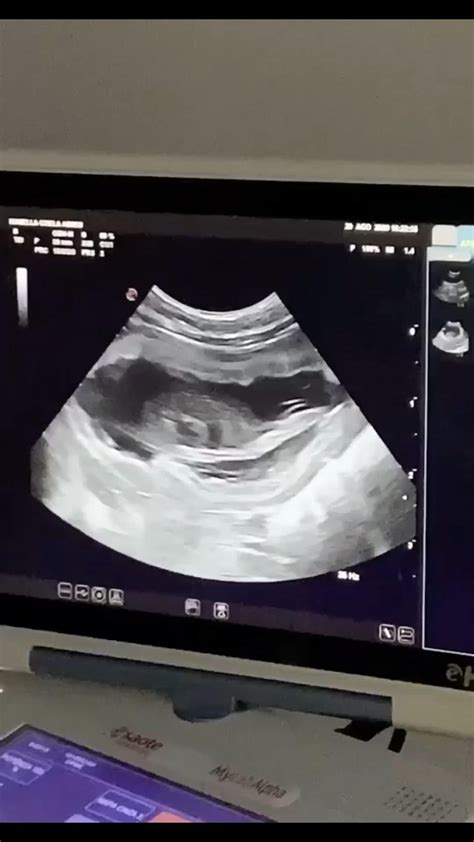 Shock Wave Lithotripsy Eswl Procedure Artofit