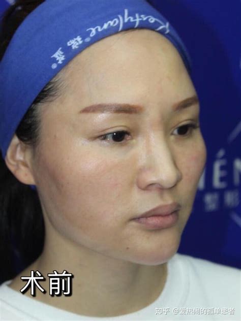 北京磨骨医院医生哪里好？内附案例 知乎