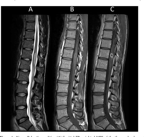 Figure 6 From It Looks Like A Spinal Cord Tumor But It Is Not