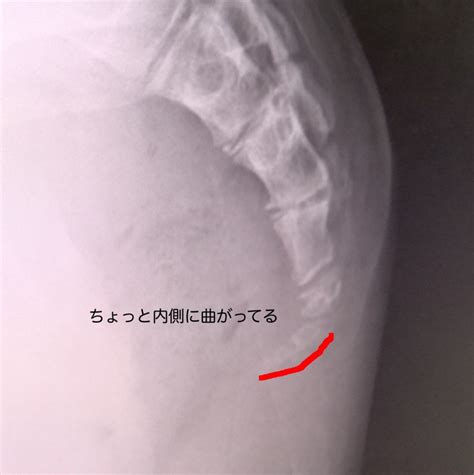 尾骨骨折？ カズの日記