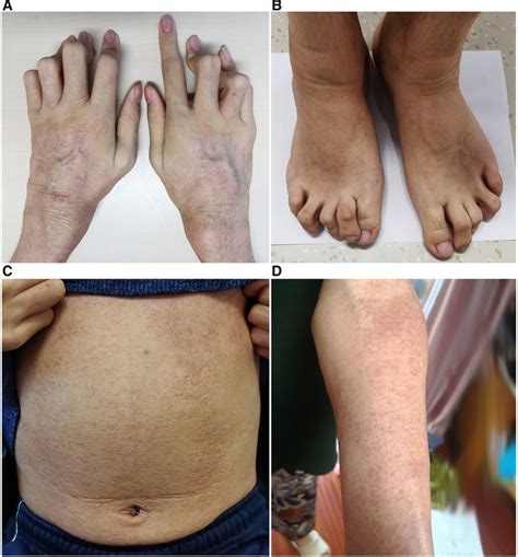 Frontiers Blau Syndrome With Hypertension And Hepatic Granulomas A