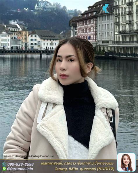 แก้ตาสองชั้น เย็บแก้กล้ามเนื้อตาอ่อนแรง ตาหวานสวยปัง ดูอ่อนเยาว์ สวย