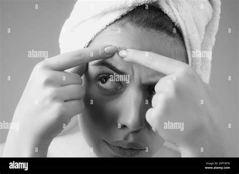 Close Up Woman Squeeze Out Pimples On Forehead Acne And Pimple On Skin