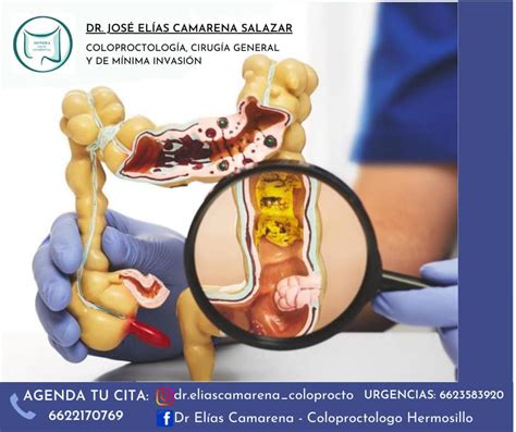 Dr Elias Camarena - Coloproctologo Hermosillo - Un Cirujano ...