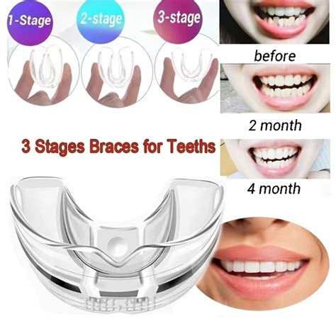 3 Stage Overnight Teeth Aligners 3 Phase Night Guard Braces Nuyu Body Sculpting